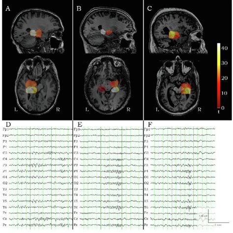 Representative Samples Of Statistical Parametric Mapping Spm Of Download Scientific Diagram