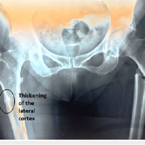 X Ray Pelvis With Hips Antero Posterior View Showing Subtrochanteric Download Scientific