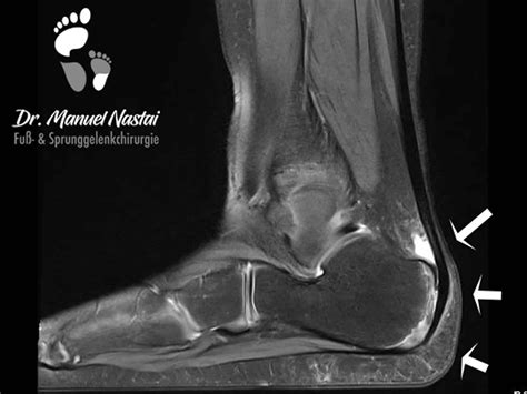 Morbus Haglund Sever Apophysitis Calcanei
