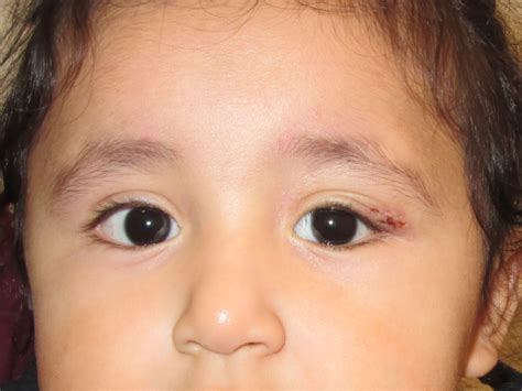 Dermoid Pediatric Eye Md Pediatric Ophthalmologists In Fresh Meadows And Woodside Queens