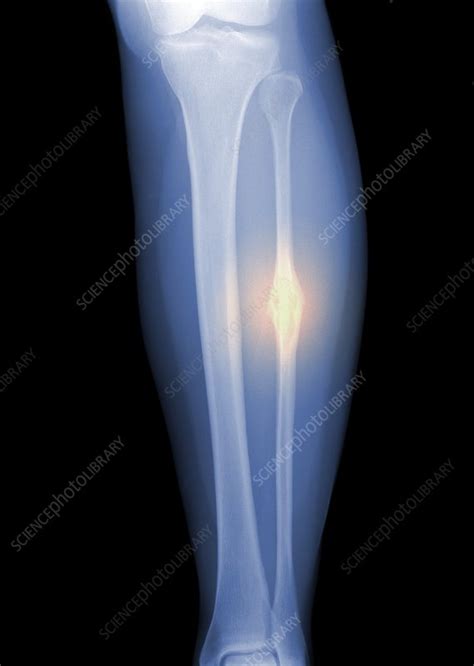 Bone Cancer X Ray Stock Image C011 9575 Science Photo Library