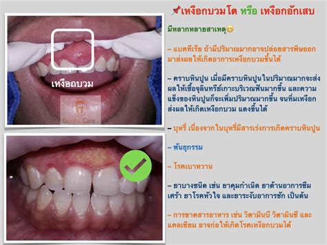 รักษาโรคเหงือก แพทย์เฉพาะทาง