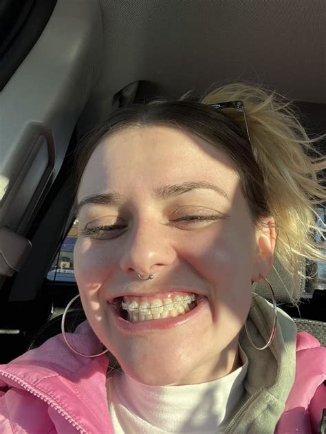 I Love Braces Rilovebraces