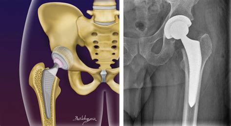Cirurgias No Quadril Dr Felipe Bessa