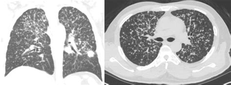 Examples Of Nsclc Patient With Miliary Lung Metastasis Download