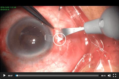 Four Point Intraocular Lens Suspension In Treating Intraocular Lens Dislocation Cjeo Journal