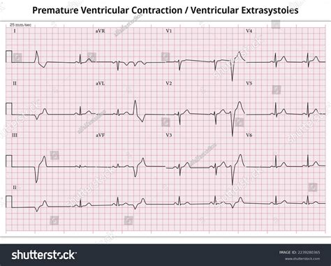 6 Afbeeldingen Voor 12 Lead Ecg Interpretation Afbeeldingen Stockfoto
