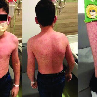 Clozapine Related Drug Reaction With Eosinophilia And Systemic Symptoms