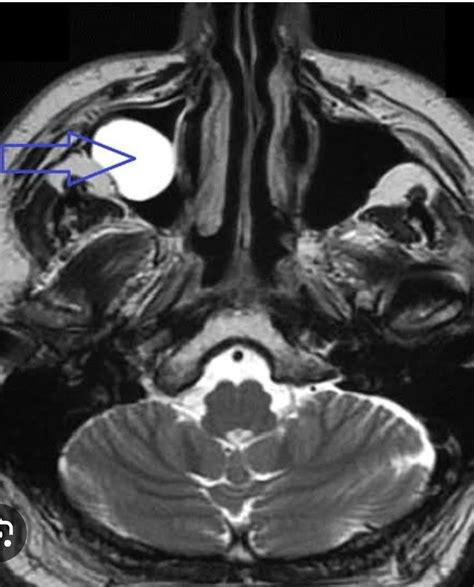 Mri Scan In Sinus Related Issues Madras Scans