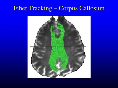 PPT MR Diffusion Tensor Imaging Tractography PowerPoint Presentation