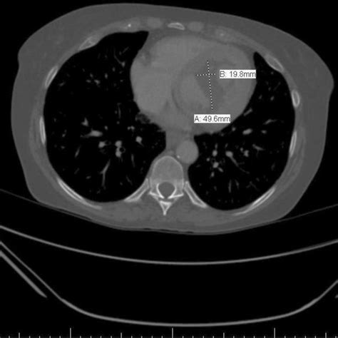 Chest Ct Demonstrating The Left Ventricular Mass Dimensions Ct