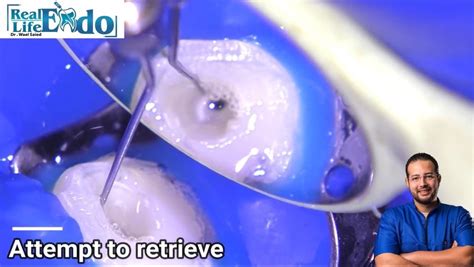 A Reffered Case Of Ultrasonic Broken File Retrieval Canal Shaping