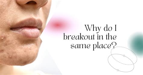 Why That Same Pimple Keeps Coming Back And How To Stop It