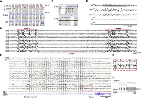 Slow Wave Oscillations And Seizure Development From Intracellular Download Scientific Diagram