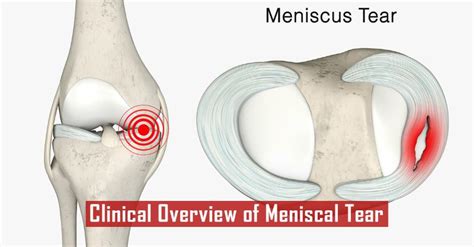 Meniscal Tear Physical Examination Diagnosis And Treatment Medsynapse