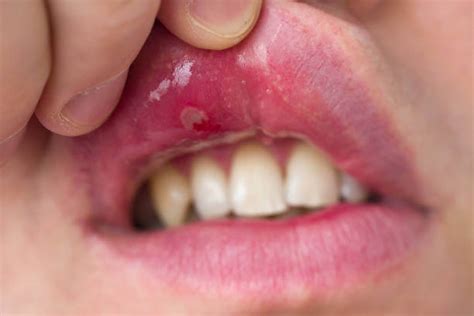 Canker Sore On Bottom Lip