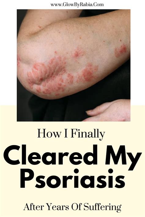 If You Have Psoriasis Your Skin Wants You To Avoid These Common Foods