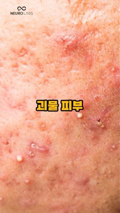 광고 괴물피부 여드름 관리방법 여드름 여드름관리 피부관리 Youtube