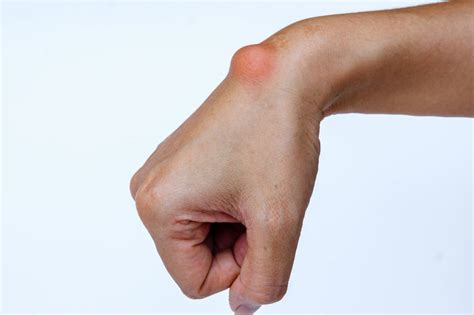 Ganglion Objawy przyczyny jak leczyć Porady w INTERIA PL