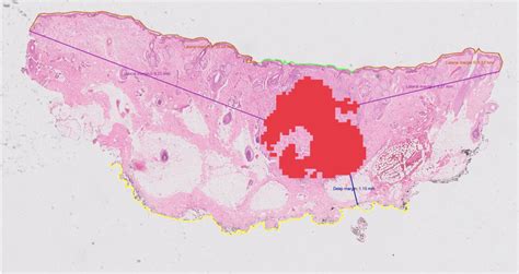 Automatic Detection Of Skin Lesions Primaa