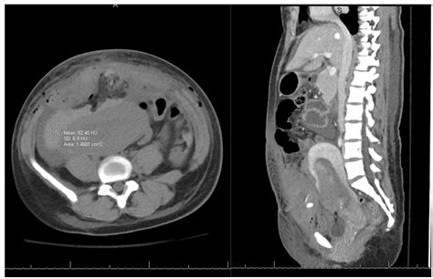 Rectus Abdominis Sheath Hematoma Following Cesarean Section A Case