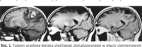 Figure 1 From Advances In The Management Of Malignant Glioma Recurrence