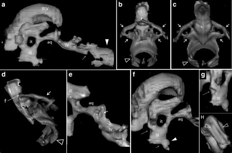 A Three Dimensional Volume Rendered Mri Image Of The Entire Ventricular