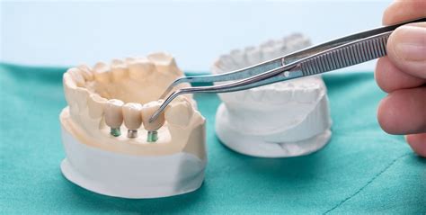 Implant Supported Bridge In Nyack Ny Dwayne M Bodie Dmd Pc