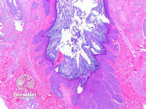 Dilated Pore Of Winer Pathology