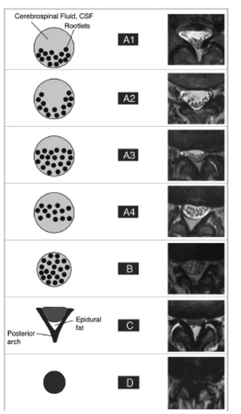 Lombaire Pinkybone Lombaire Pinkybone