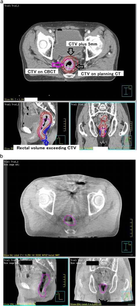 Contouring Of The Rectum On Planning Ct A And Cbct On 7 Days B In Download Scientific