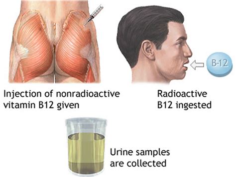 Schilling Test For Pernicious Anemia And Schilling Test Procedure