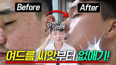 효과적인 여드름 관리 깨끗한 피부를 위한 팁