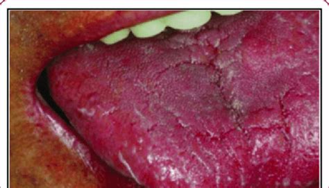 Thrush In The Elderly And Adults Welzo