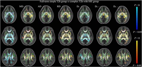Tract Based Spatial Statistics For Comparisons Between Full Term Simple