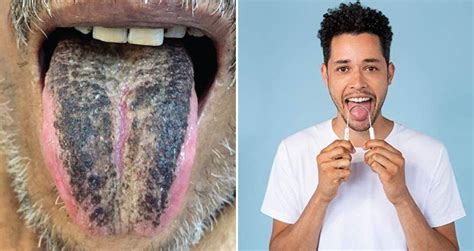 Black Hairy Tongue Symptoms Causes Treatment