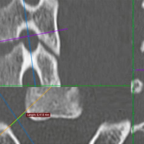 Measurement Of Foraminal Height Download Scientific Diagram