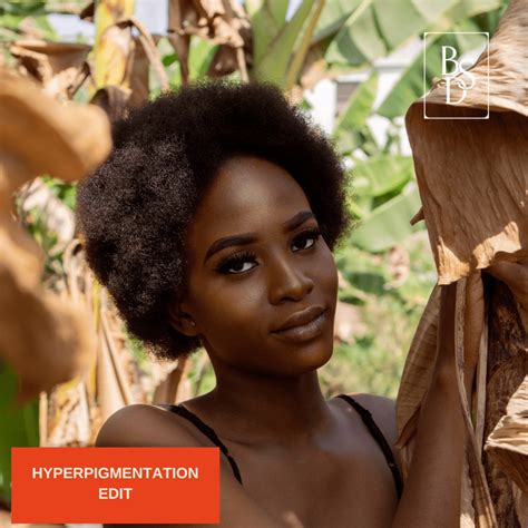 How To Treat Prevent And Fade Hyperpigmentation — Black Skin Directory