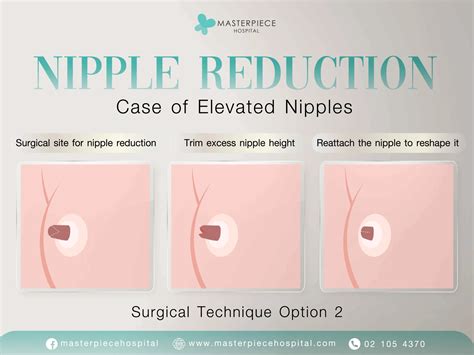 Nipple Reduction An Easy Solution For Enlarged Nipples