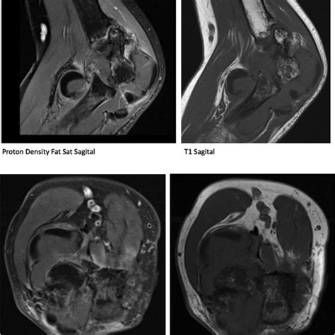 MRI Of The Left Elbow 3 Years After Initial X Ray PD FS And T1W