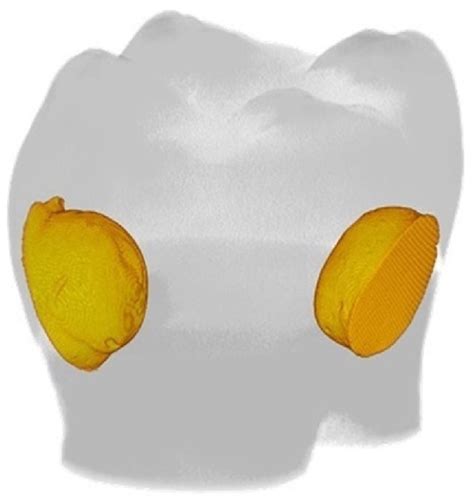 Figure 1 From Internal Adaptation Of Composite Fillings Made Using Universal Adhesives—a Micro