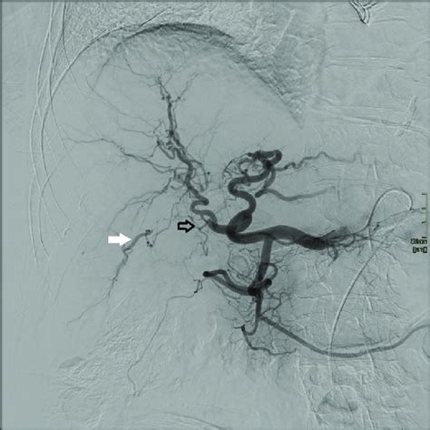 On This DSA Image The Black Hollow Arrow Indicates Occlusion Of The