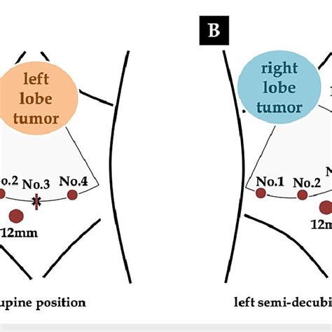Trocar Placement Of Robotic Liver Resection For Left Lobe Tumors A