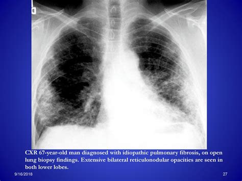 Interstitial Lung Disease And Sarcoidosis Ppt Download