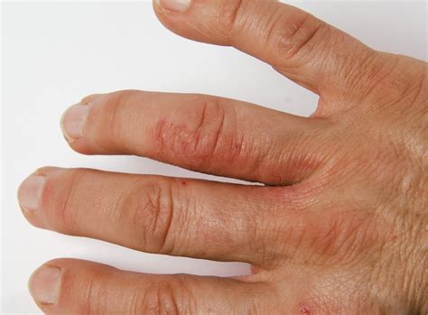 Dactylitis A Clinical Marker For A More Severe Phenotype In Dmard Naive Early Psa