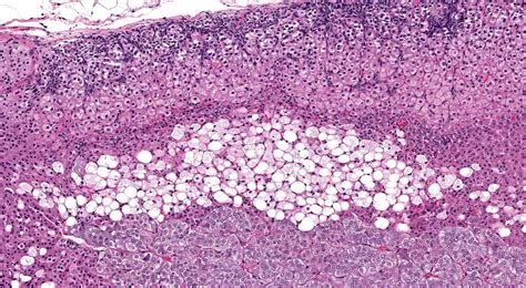 Cytoplasmic Vacuolation