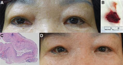 Rare Respiratory Epithelial Cyst Masquerading As Conjunctivi Ophthalmic Plastic