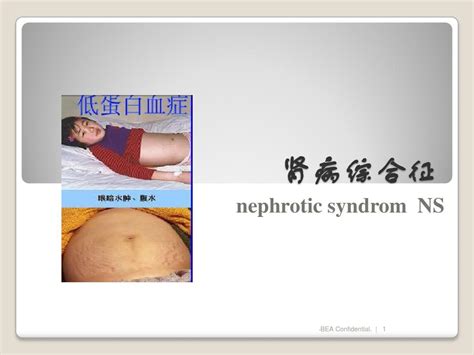 29肾病综合征病人护理word文档在线阅读与下载无忧文档