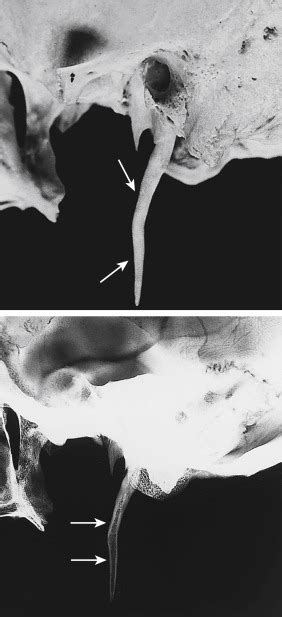 Styloid Process Injection For Eagle Syndrome Anesthesia Key