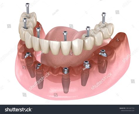 Mandibular Prosthesis All On 4 System Stock Illustration 1891467733
